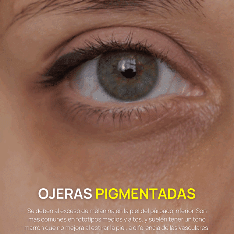 Ojeras: Descubre los Tipos, sus Causas y el Tratamiento para una Mirada ...